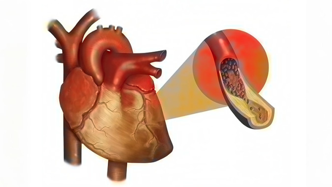 Strategies to Optimize Lipid Control | myCME